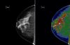 Detecting Breast Cancer Might Now Be Easier With Underwater Imaging ...