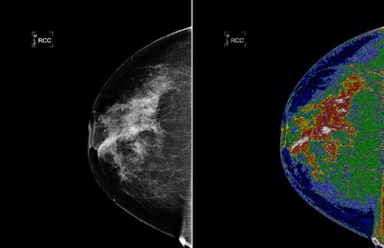Radiation-Free Alternative to Mammogram is in the Works - Good News Network