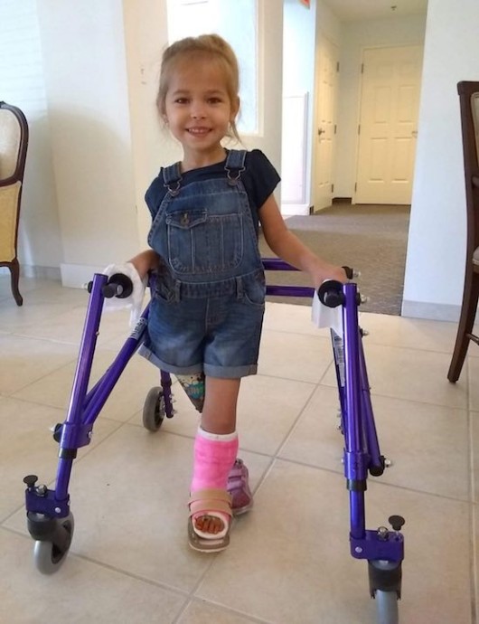 Girl Born With Backwards Legs Walks for the First Time Thanks to ...
