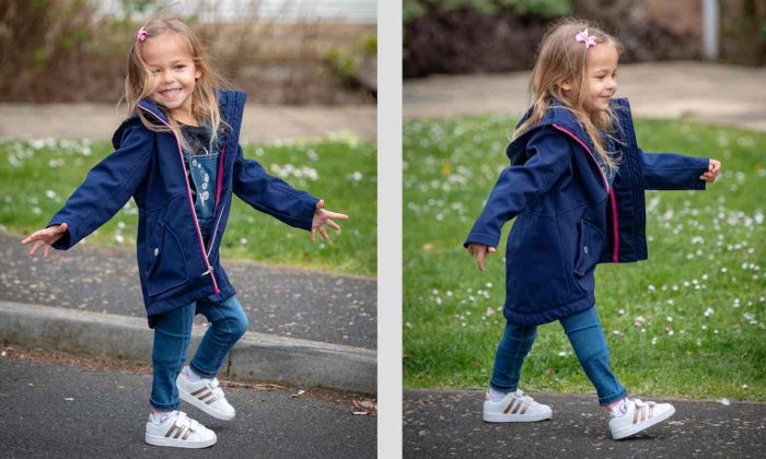 Girl Born With Backwards Legs Walks for the First Time Thanks to ...