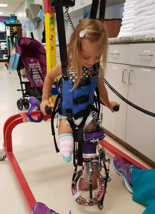 Girl Born With Backwards Legs Walks for the First Time Thanks to ...
