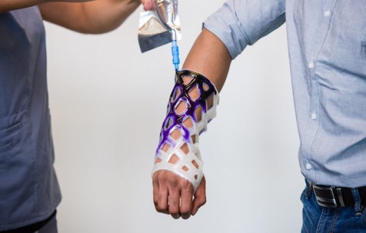 Revolutionary New Arm Cast is Waterproof, Breathable, and Itch-Free