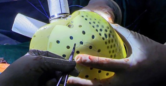 39-Year-Old Becomes First US Patient to Receive Innovative Artificial ...