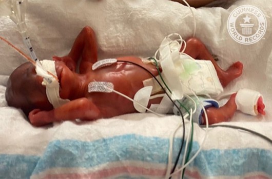 World's Most Premature Baby Defies 1% Survival Odds to Break Guinness ...