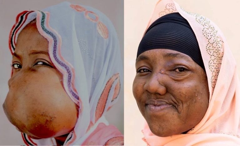 Mom Whose Facial Tumor Left Her Barely Able to Eat Now Lives Normal ...