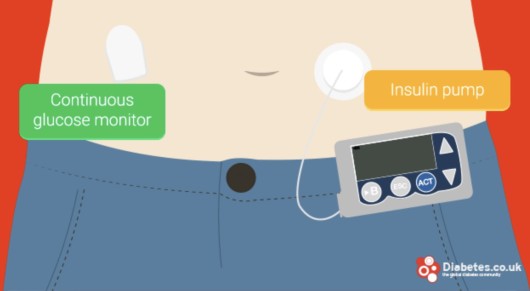 New Artificial Pancreas for Type 2 Diabetes Manages Blood Sugar Twice ...