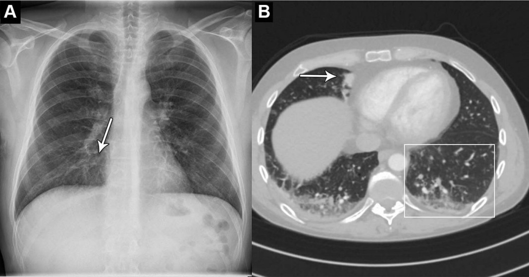 Artificial Intelligence 'Can Help Spot Early Signs of Cancer in Chest X ...