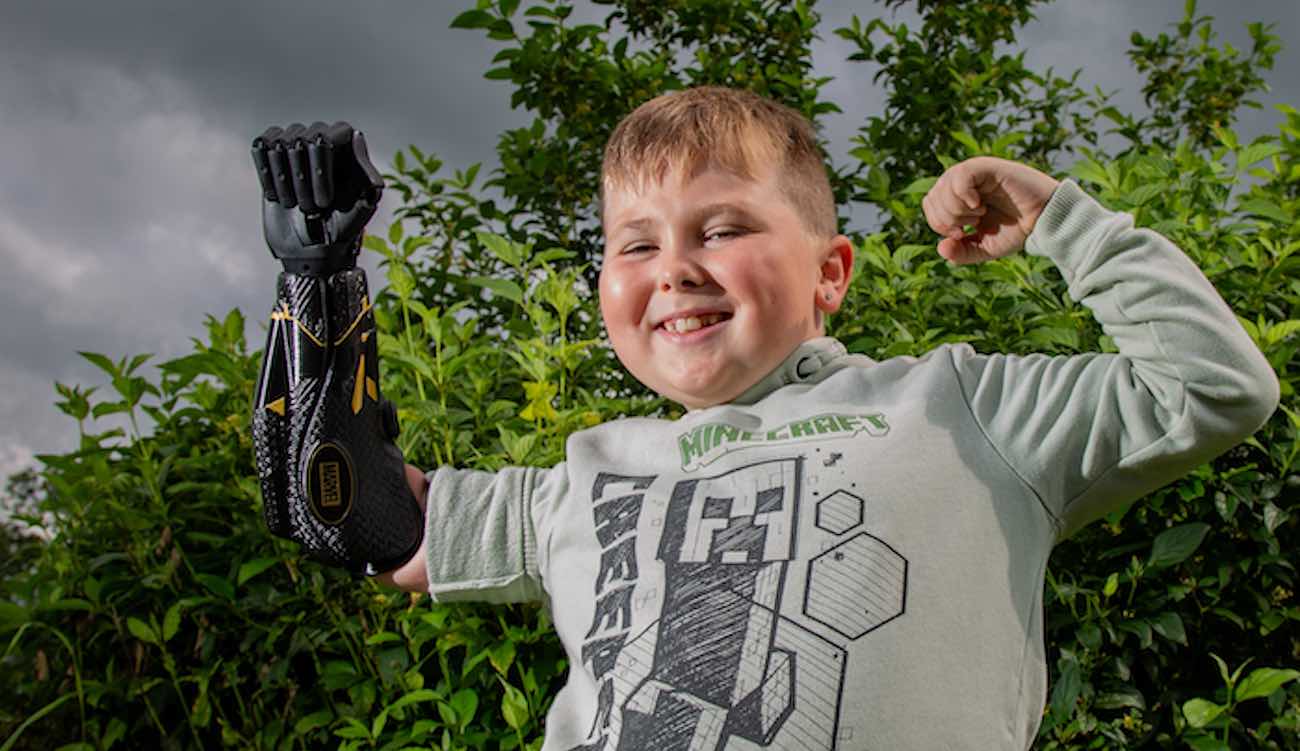 Armless 7-Year-old Boy Gets to Finally Go Fishing–After Donation of a ...