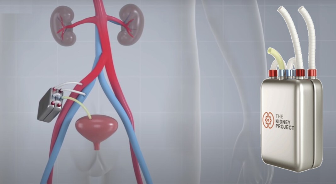 Implantable Artificial Kidney That Frees Patients From Dialysis On ...