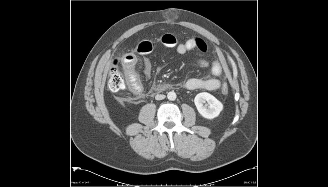 Single-Dose of Gene Therapy Hailed as ‘Magic Wand’ for Patients with ...