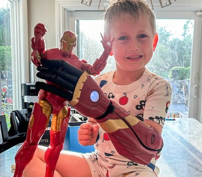 5-Year-old Boy Becomes Youngest Ever to Receive a Bionic Arm and is ...