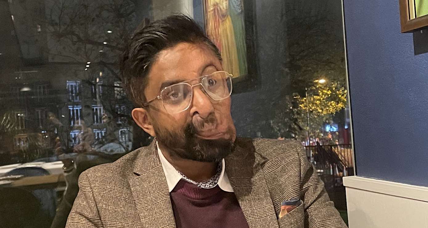 Bullied Man With Facial Disease Quits Job to Speak to Schools And Help Kids With Differences