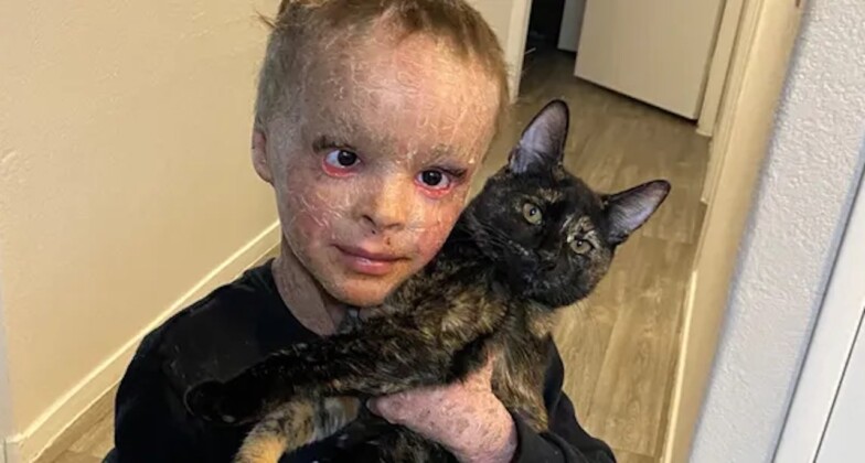 Boy with Rare Skin Condition Can Sleep with Eyes Closed for The First ...