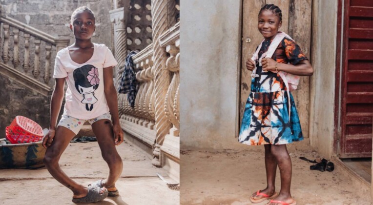 Schoolgirl With Severely Bowed Legs Gets Life-Changing Surgery to ...