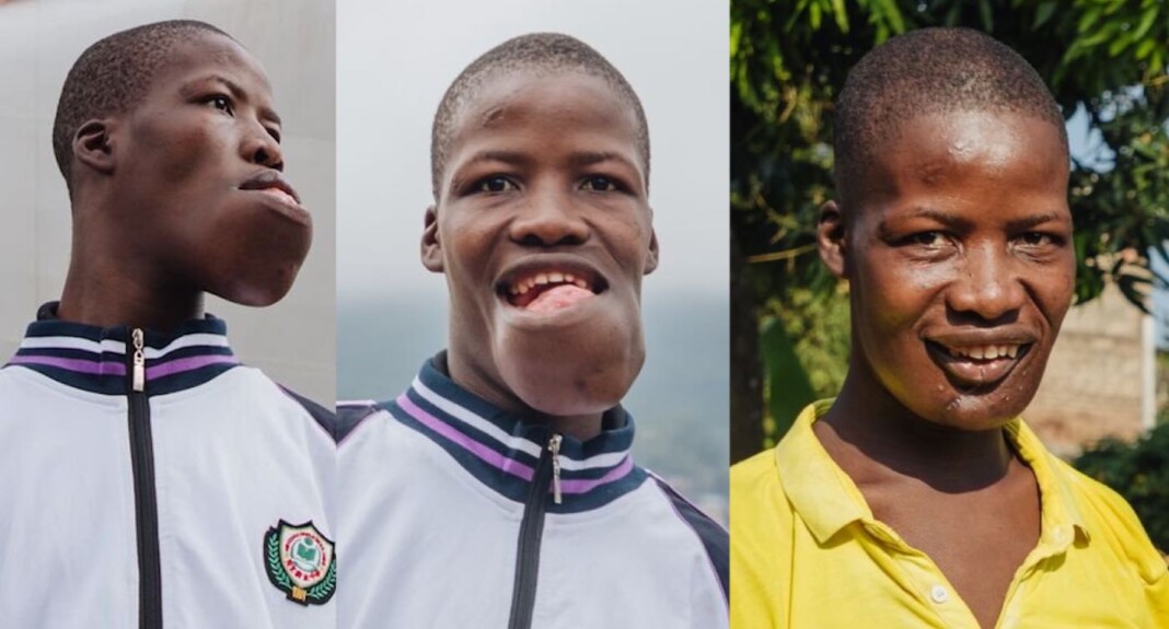 Man Gets Free Life-Changing Surgery to Remove Baseball-sized Tumor from ...