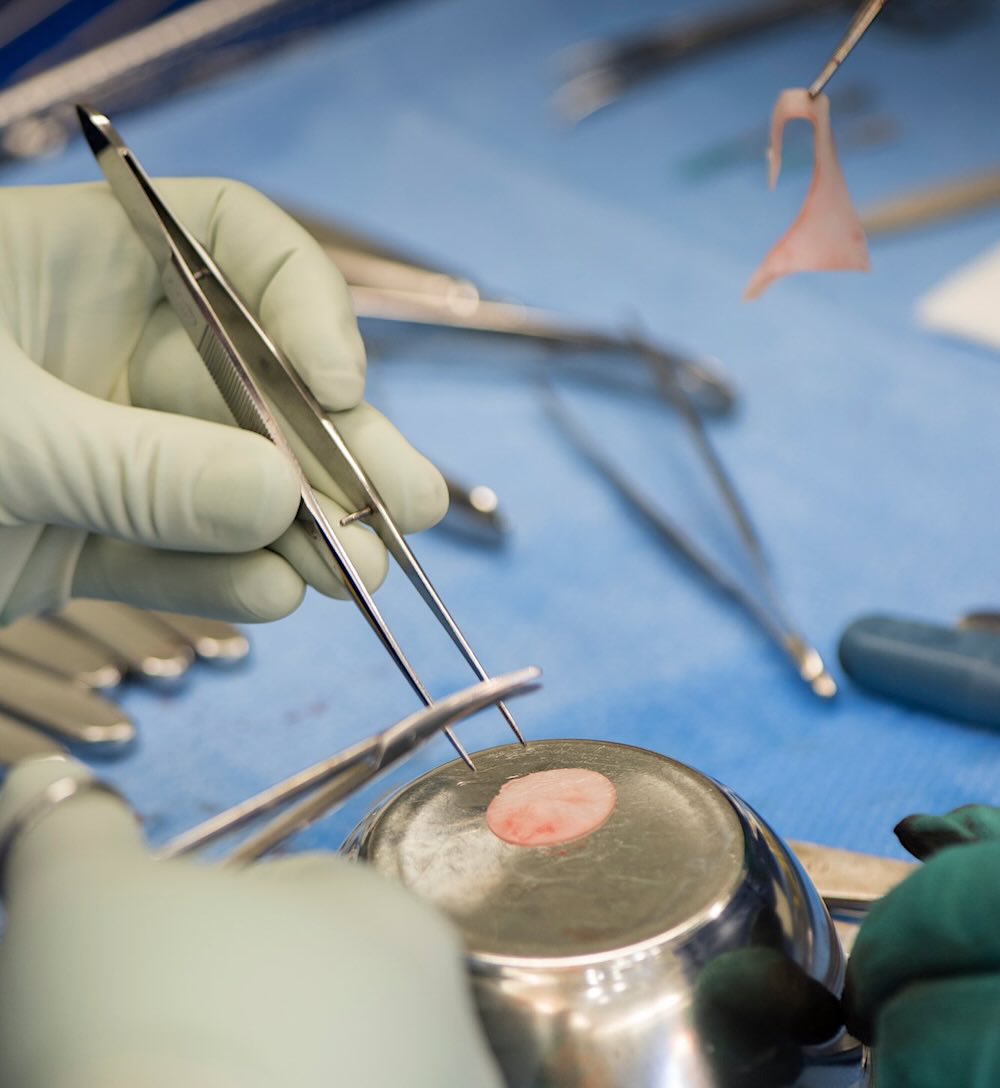 Serious Knee Injury Repairs ‘Significantly’ Improved With Cartilage ...