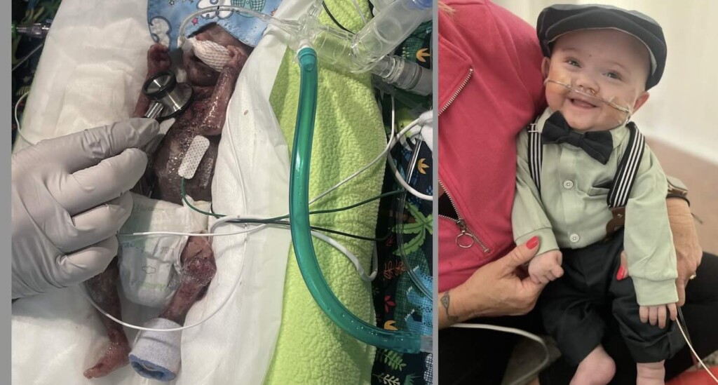 Guinness Record Holder for Most Premature Baby is Thriving at 1-Year ...