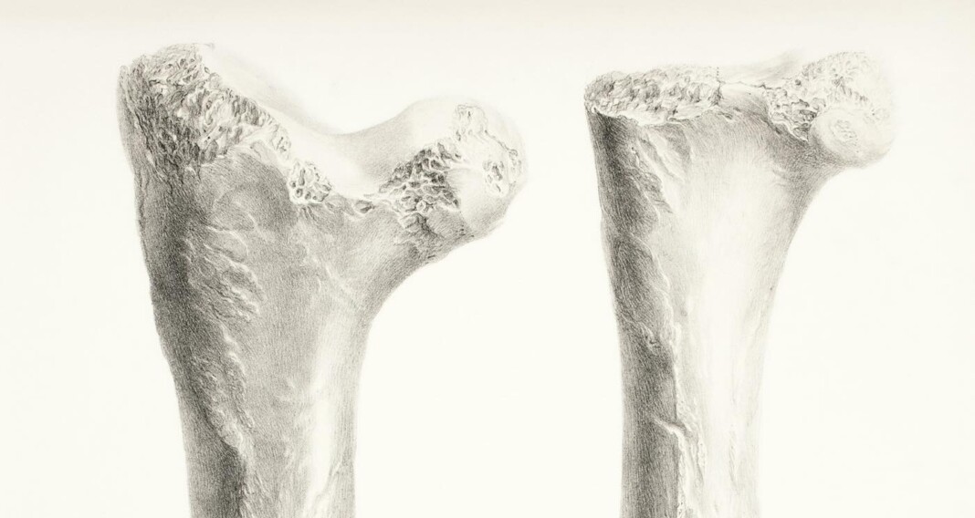 Scientists Find a Switch That Could Stop Osteoporosis, Making Bones ...